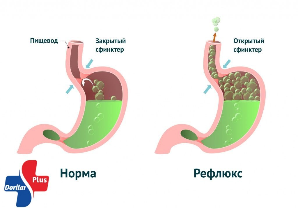 Meteorizm haqida: ⋆ WWW.SAVOL-JAVOB.COM